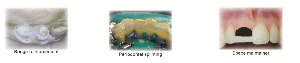 Splinting ribbon | Perident